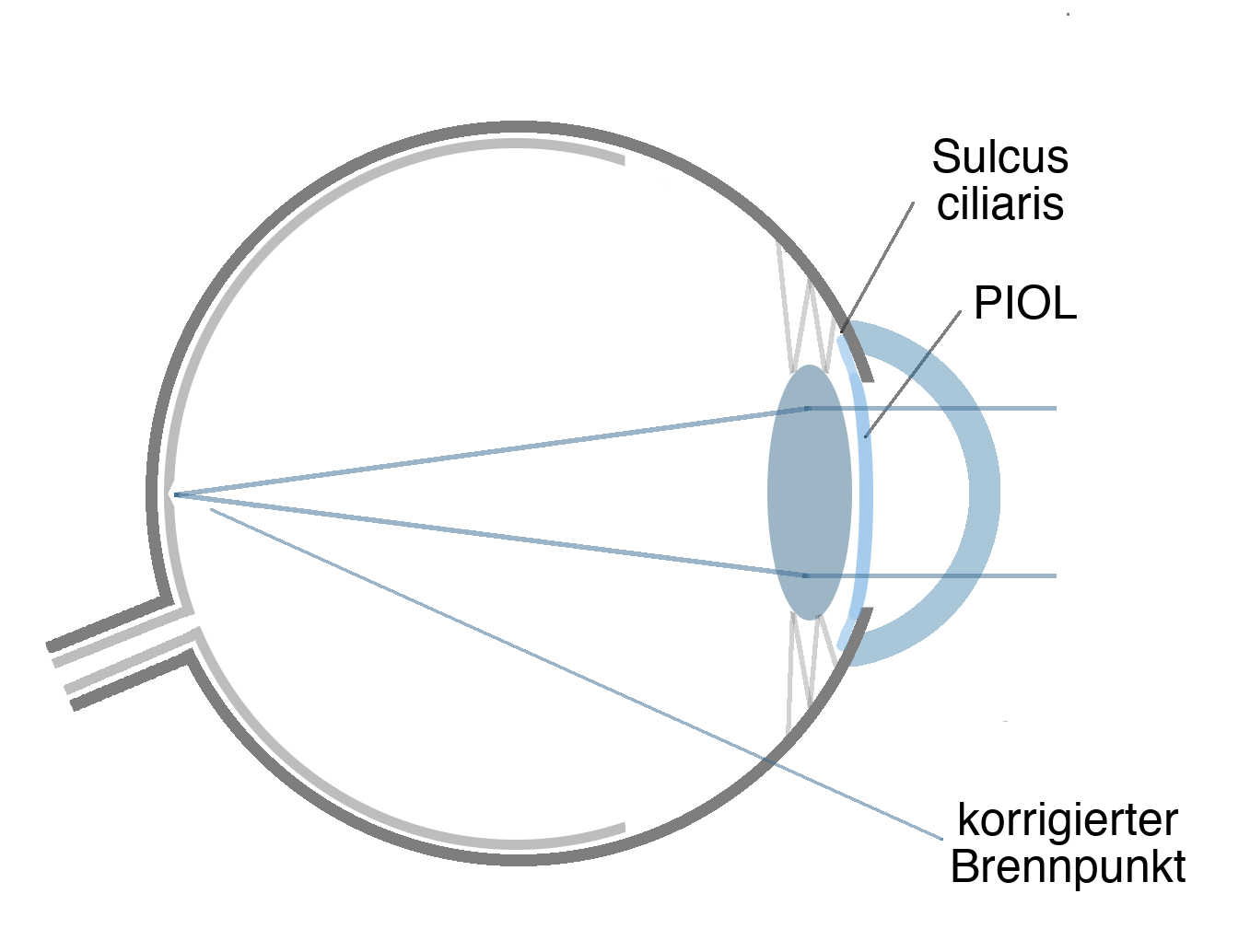 Augenlaser und Linsenchirurgie im Vergleich| EyeZurich