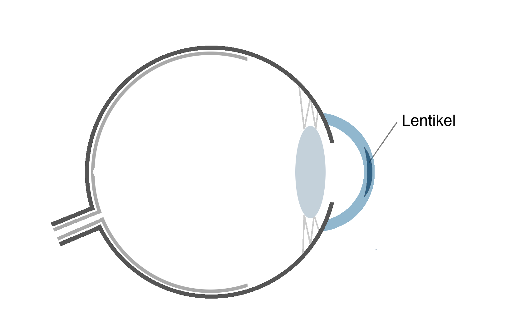 Augenlaser und Linsenchirurgie im Vergleich| EyeZurich