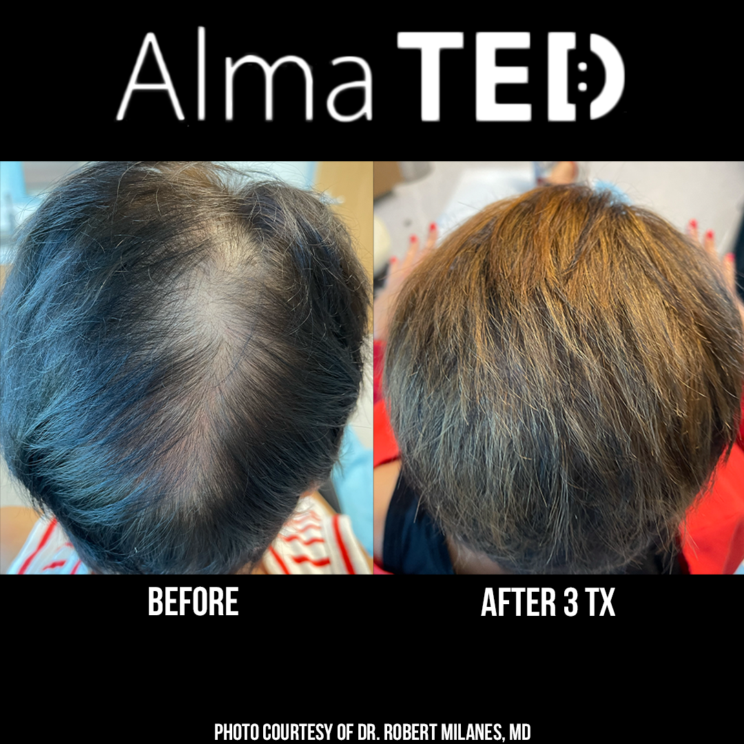 Alma TED Hair Loss Restoration | Luminary MD