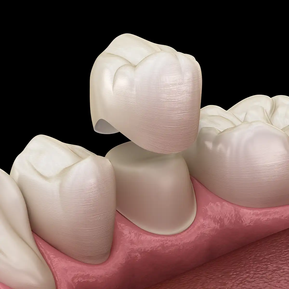 Crowns | Foggo Dental Practice | Barrhead Dentist Glasgow | NHS ...