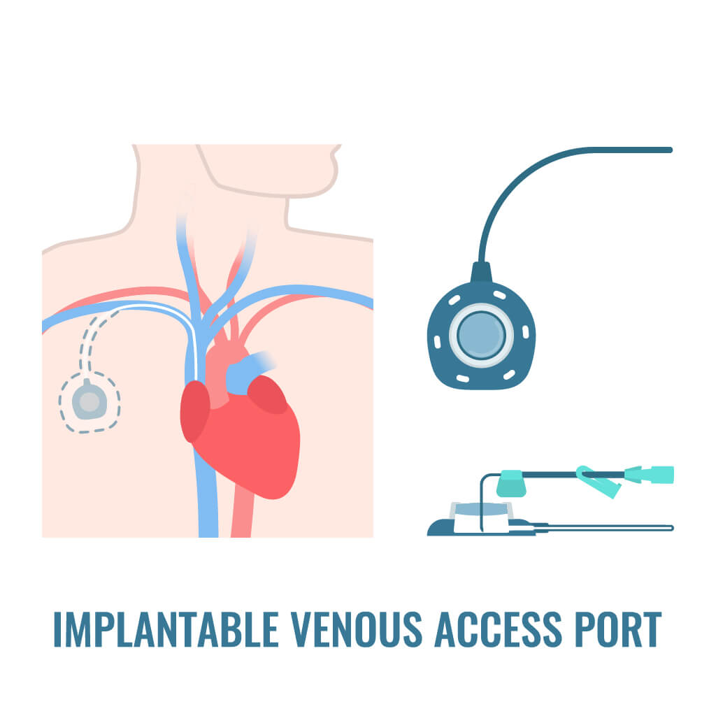 Port Clinic | Vascular & Interventional Partners