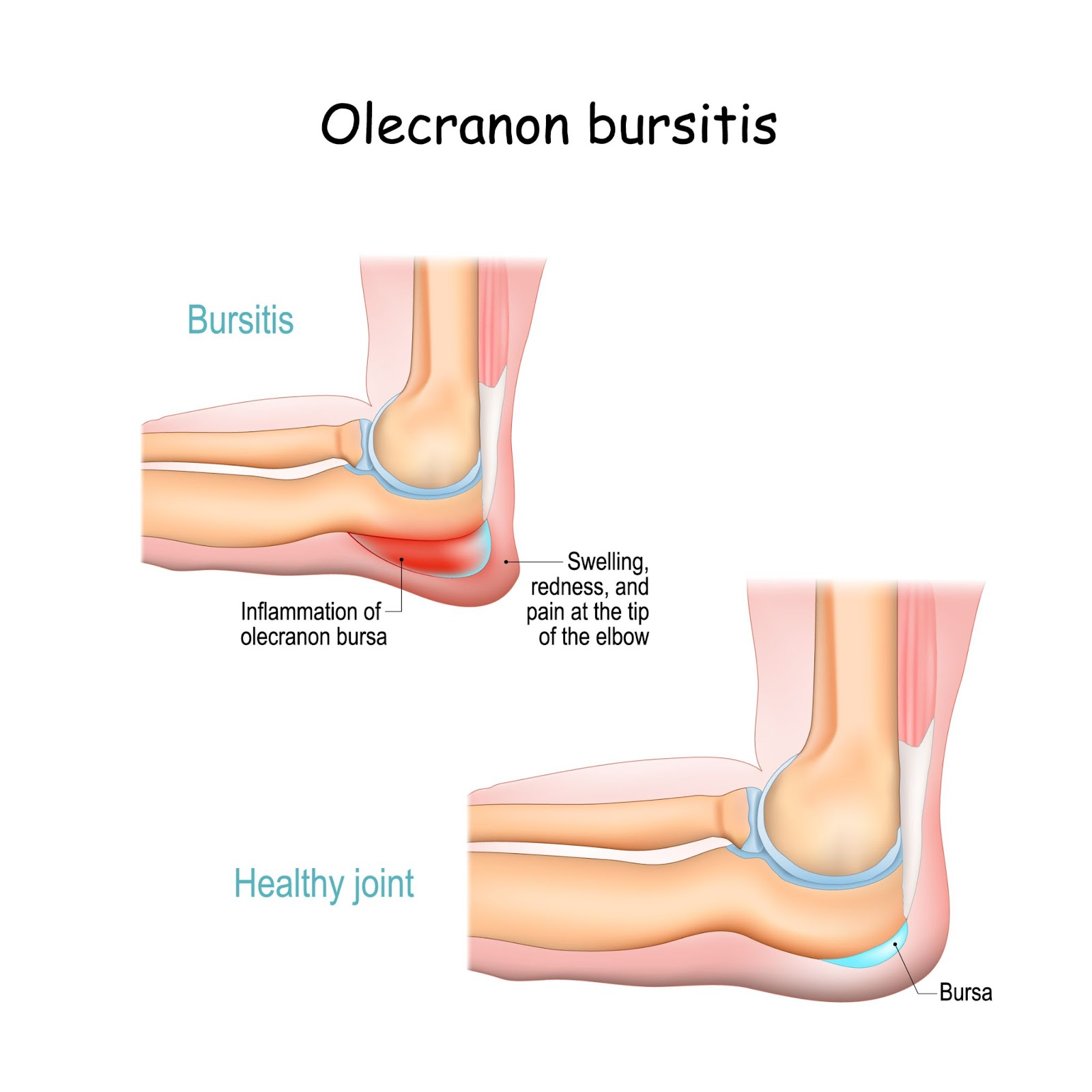 Olecranon Bursitis