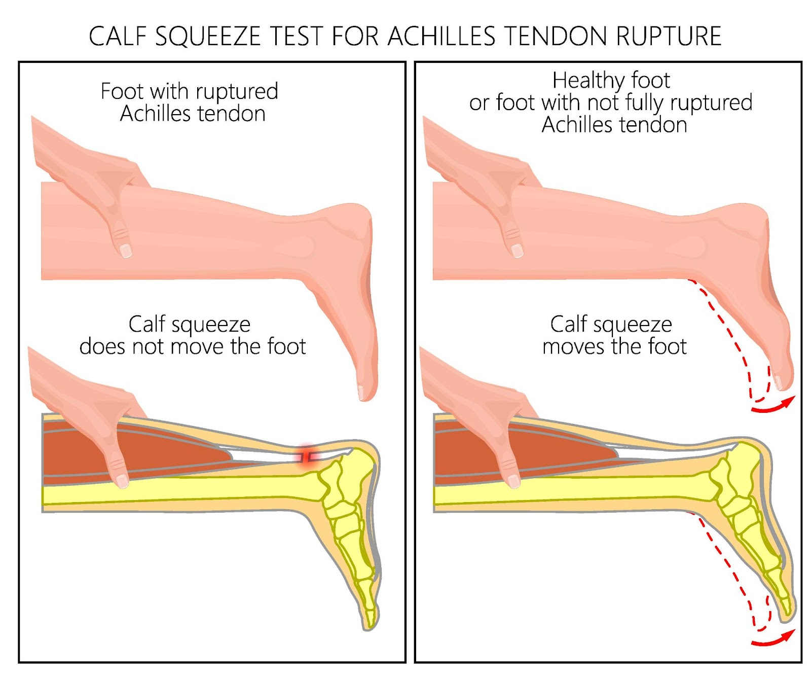 Achilles Tendon Rupture