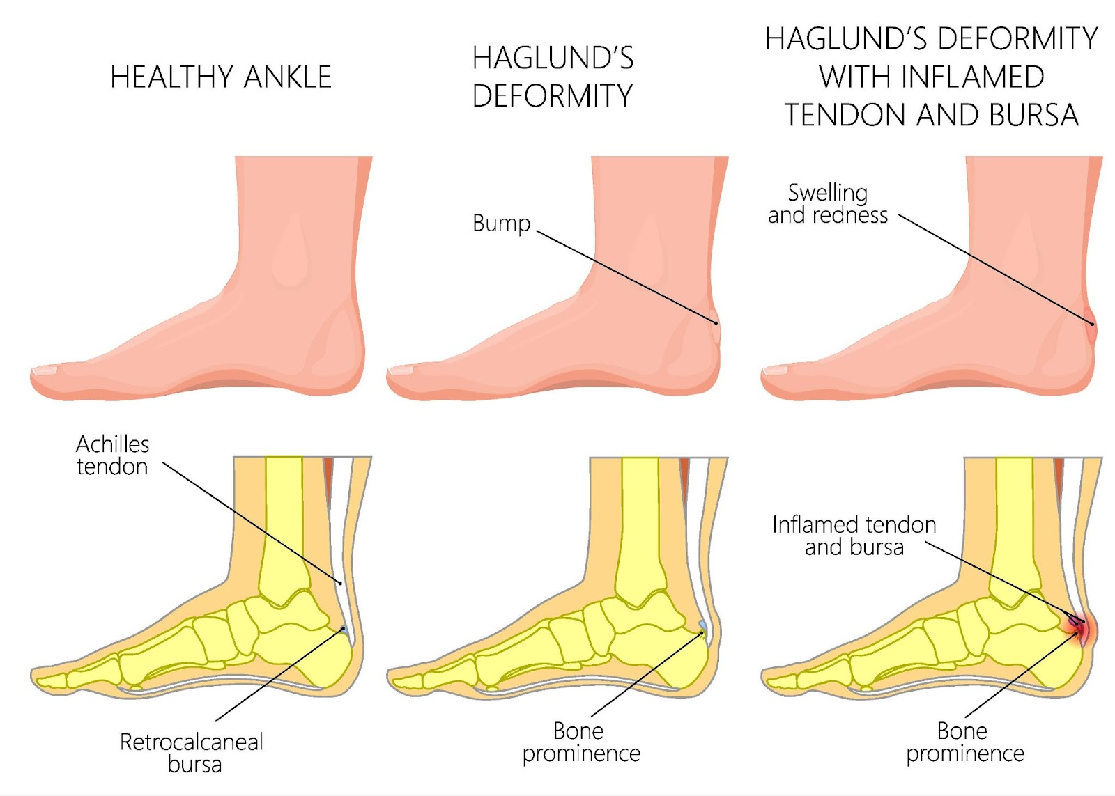 Haglund Deformity