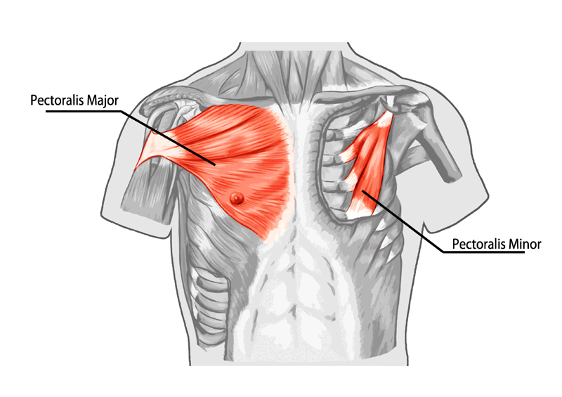 Pectoralis Major Rupture