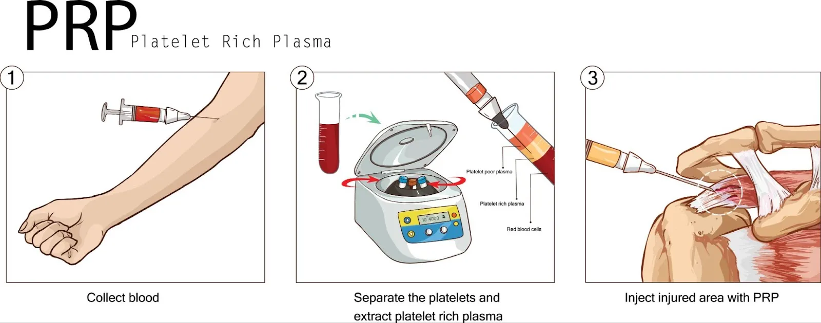 Platelet-Rich Plasma (PRP) Injection