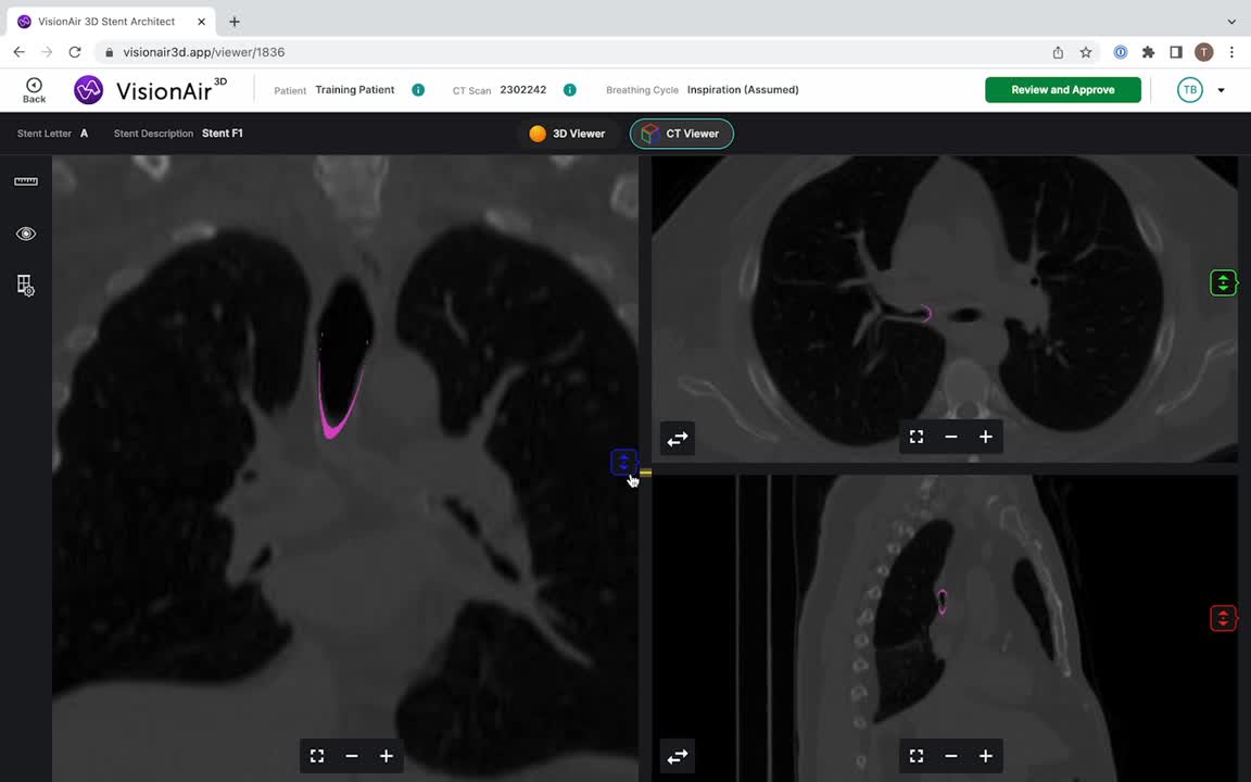 Patient-Specific Stents
