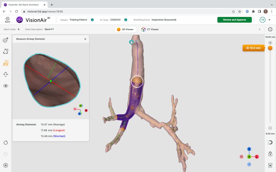 Patient-Specific Stents