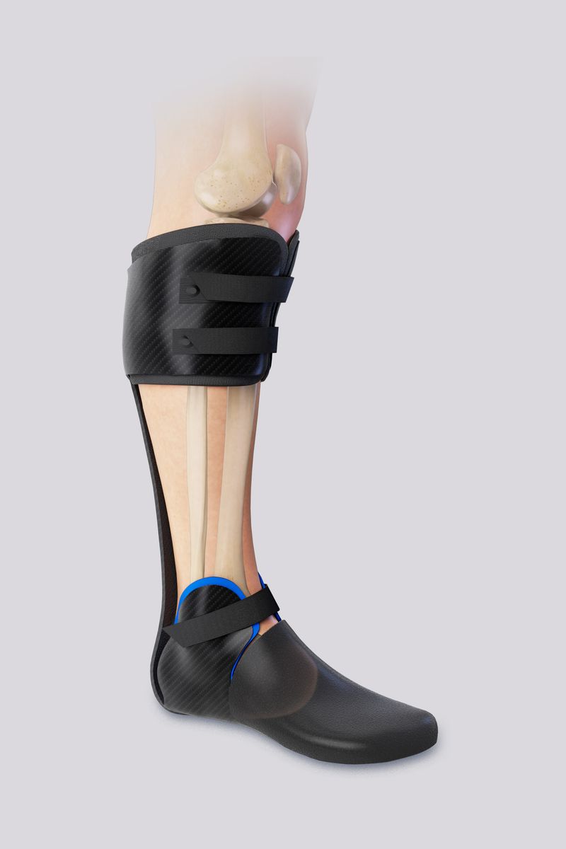 Partial Foot Prosthesis