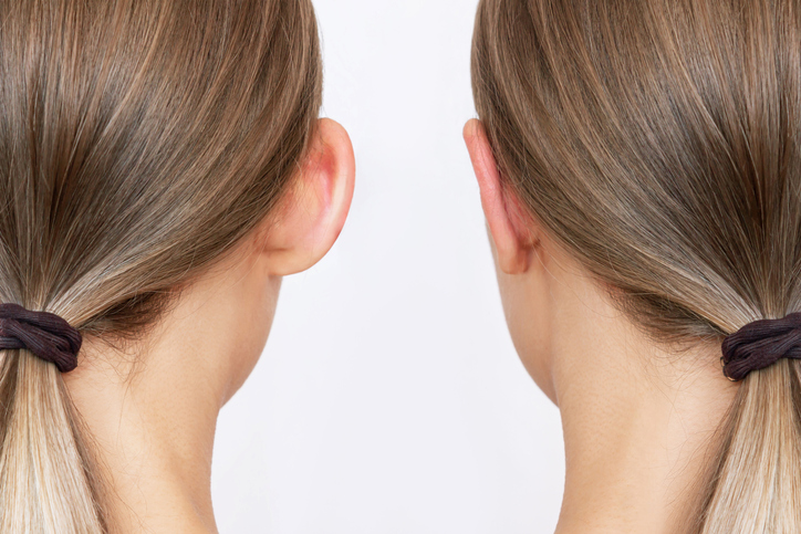 Otoplasty (Prominent Ear Correction) Tauranga | Butler Plastic Surgery