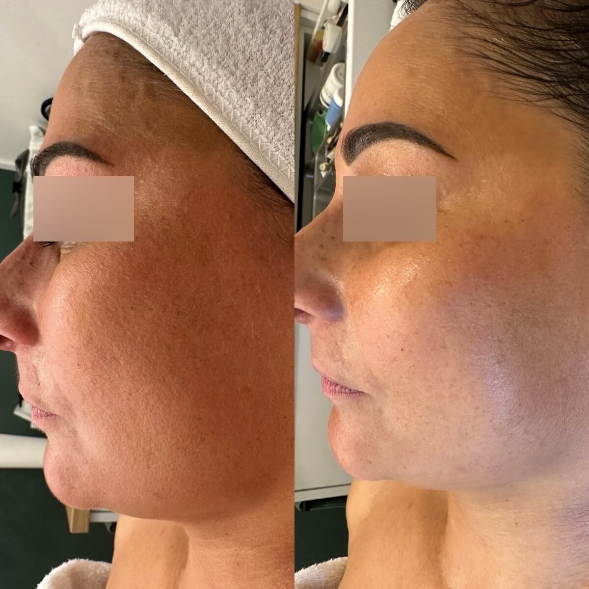 Dry Skin Causes, Tips and How To Treat It | Hawthorne Skin & Beauty