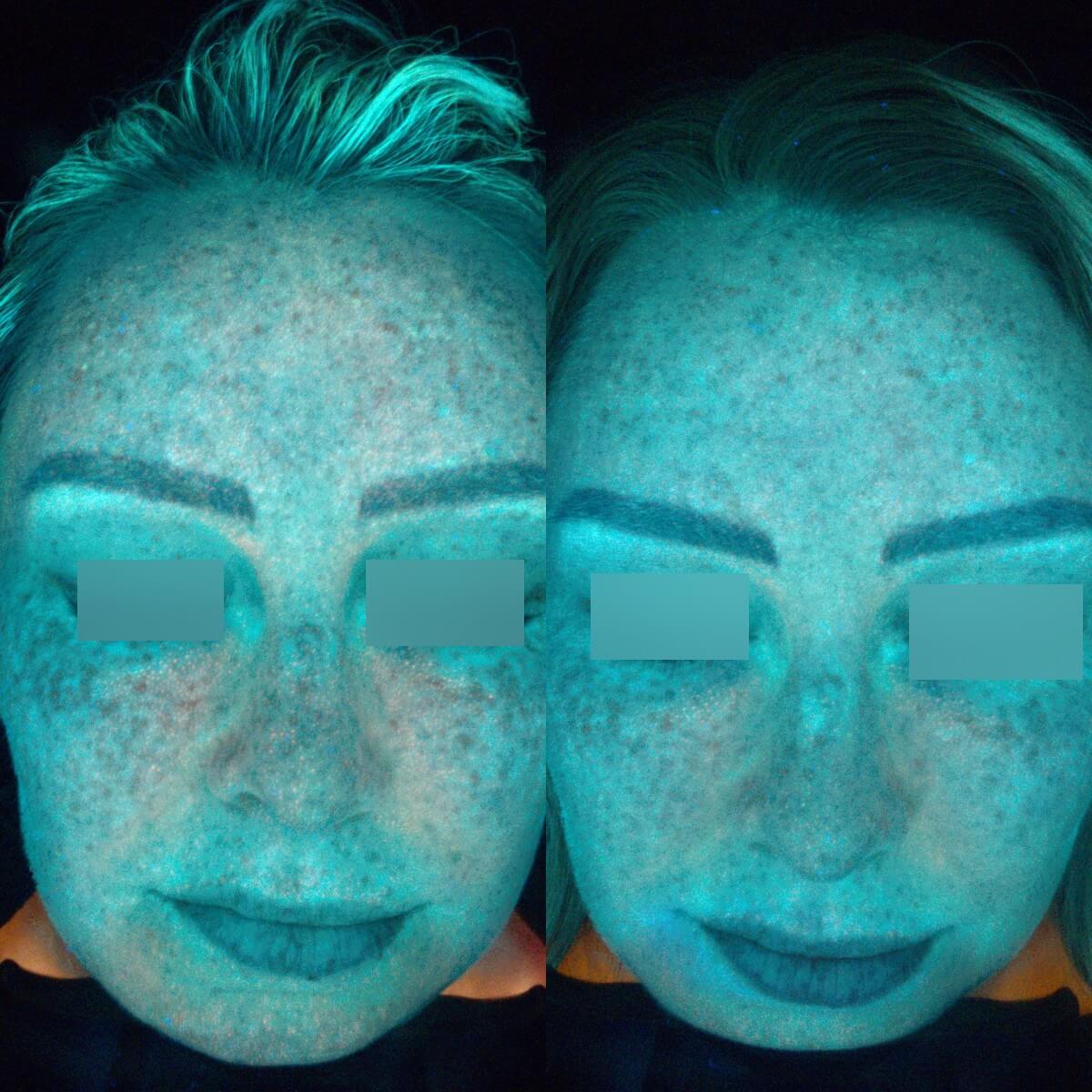 Oily Skin Causes, Tips and How To Treat It | Hawthorne Skin & Beauty