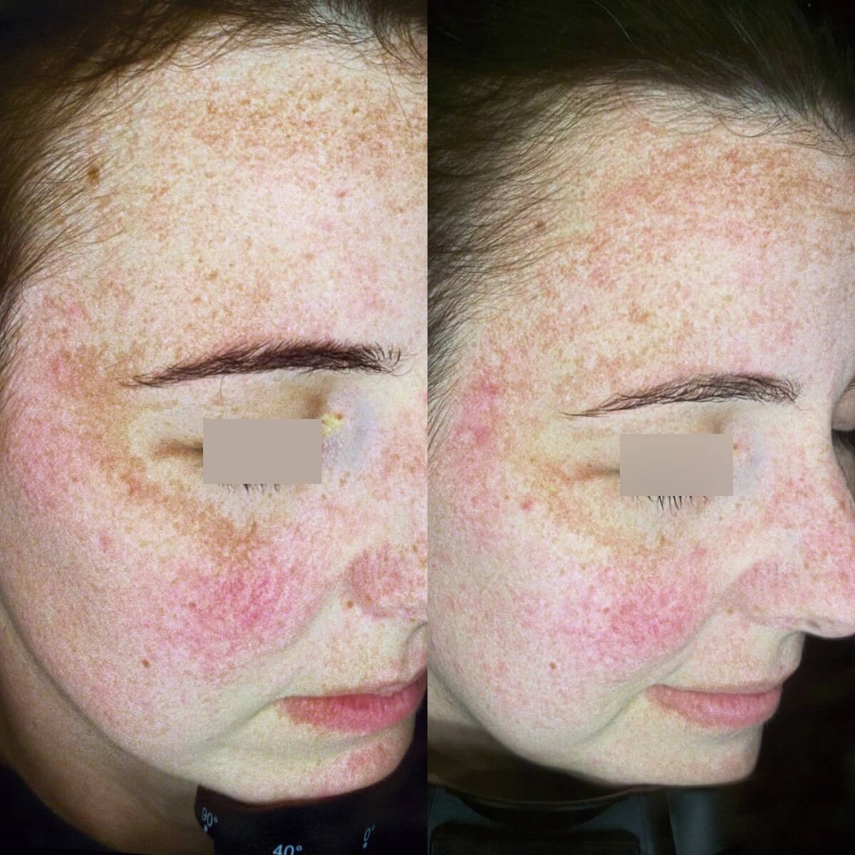 Pigmentation & Discoloration Causes, Tips and How To Treat It ...