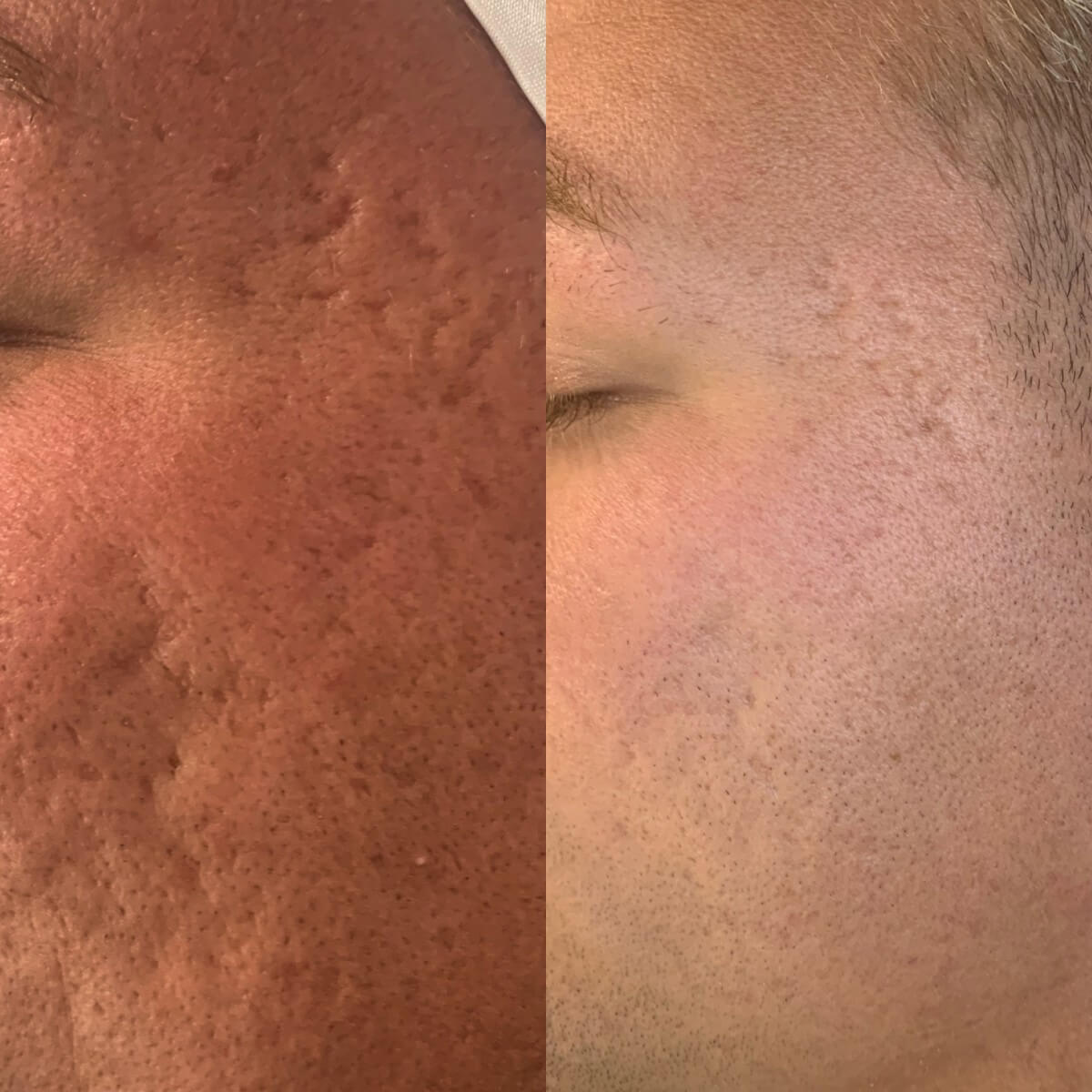 Scarring Causes, Tips and How To Treat It | Hawthorne Skin & Beauty