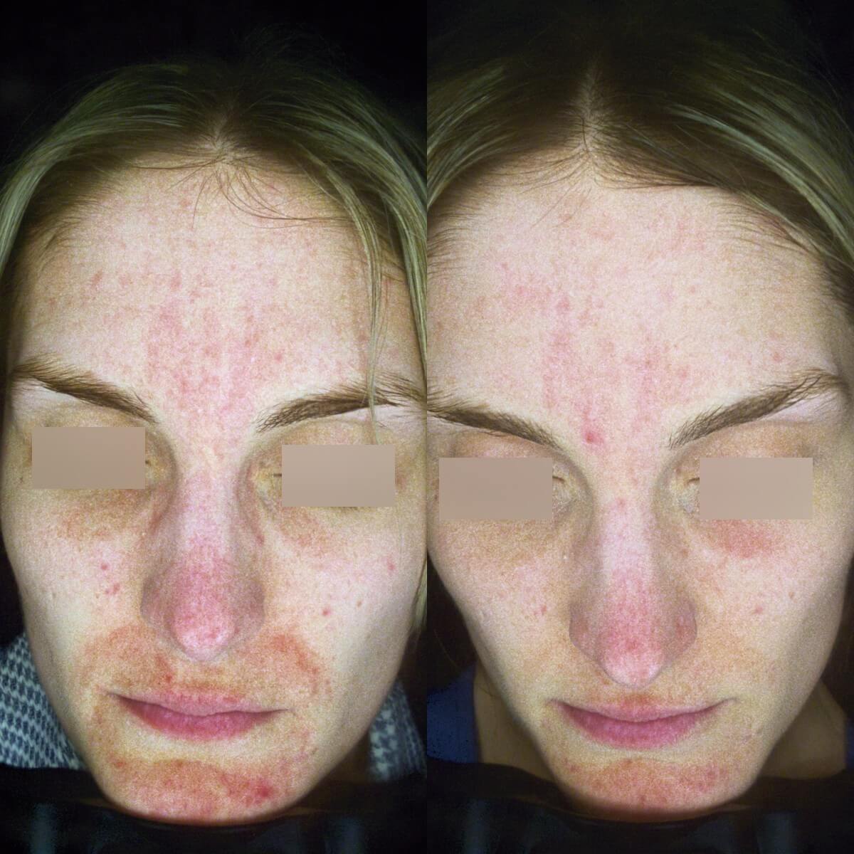 Sensitive Skin Causes, Tips and How To Treat It | Hawthorne Skin & Beauty