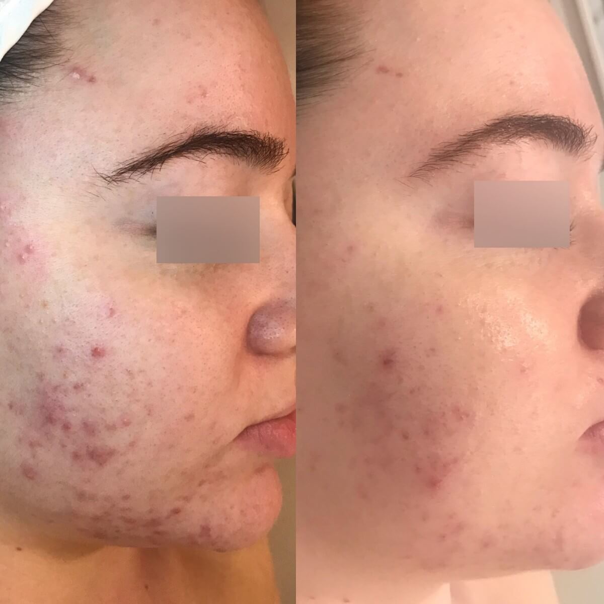 Acne & Breakouts Causes, Tips and How To Treat It | Hawthorne Skin & Beauty