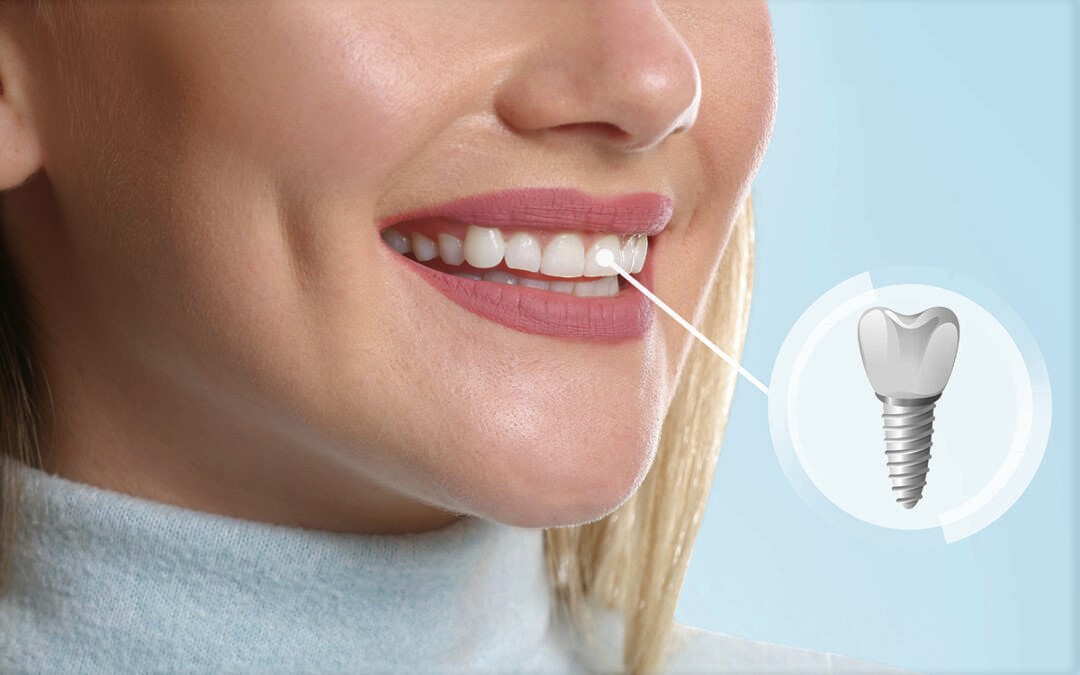 Single Implants - Montero Smile Art