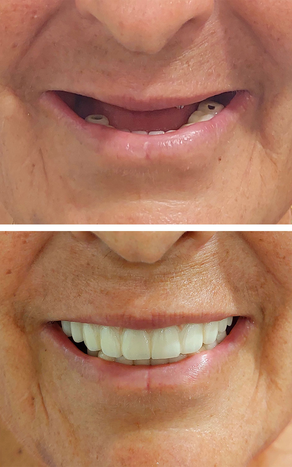 Full Mouth Restoration - Montero Smile Art