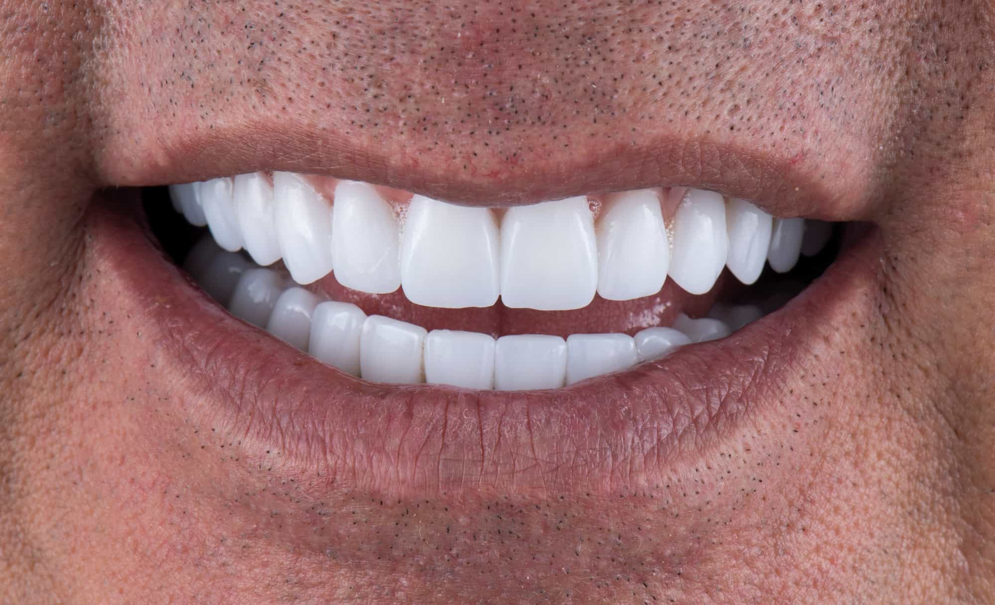 Full Mouth Restoration - Montero Smile Art