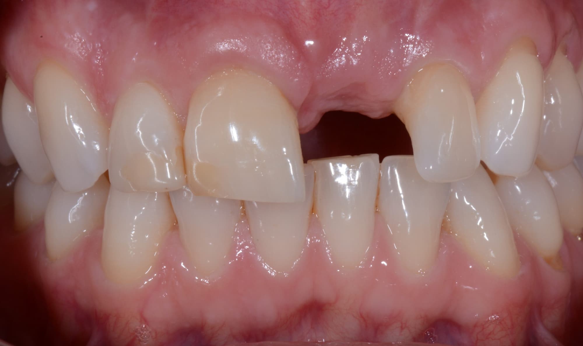 Consequences of tooth loss: Restoring Your Smile and Oral Health