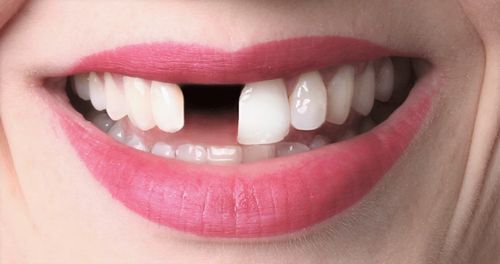 Consequences of tooth loss: Restoring Your Smile and Oral Health