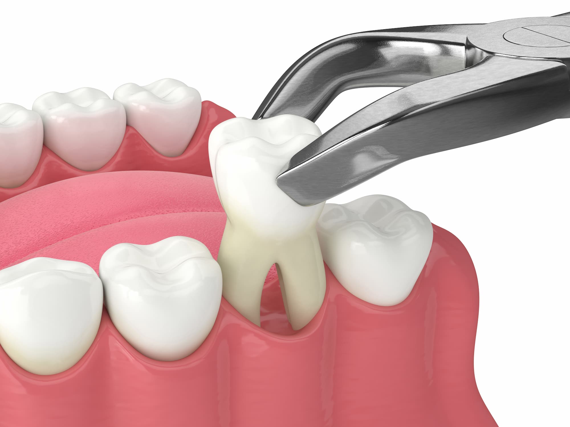 Consequences of tooth loss: Restoring Your Smile and Oral Health