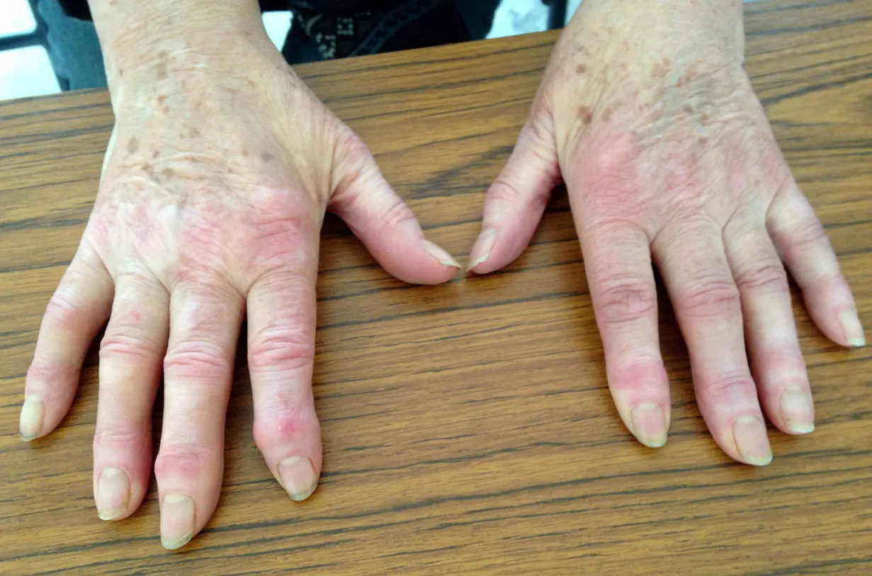 Health Problems Photo Gallery | The Burghwood Clinic