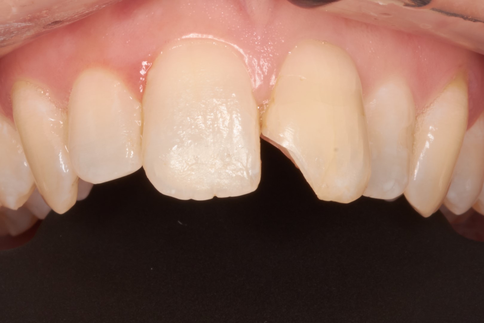 Frontal Incisor Composite Restoration