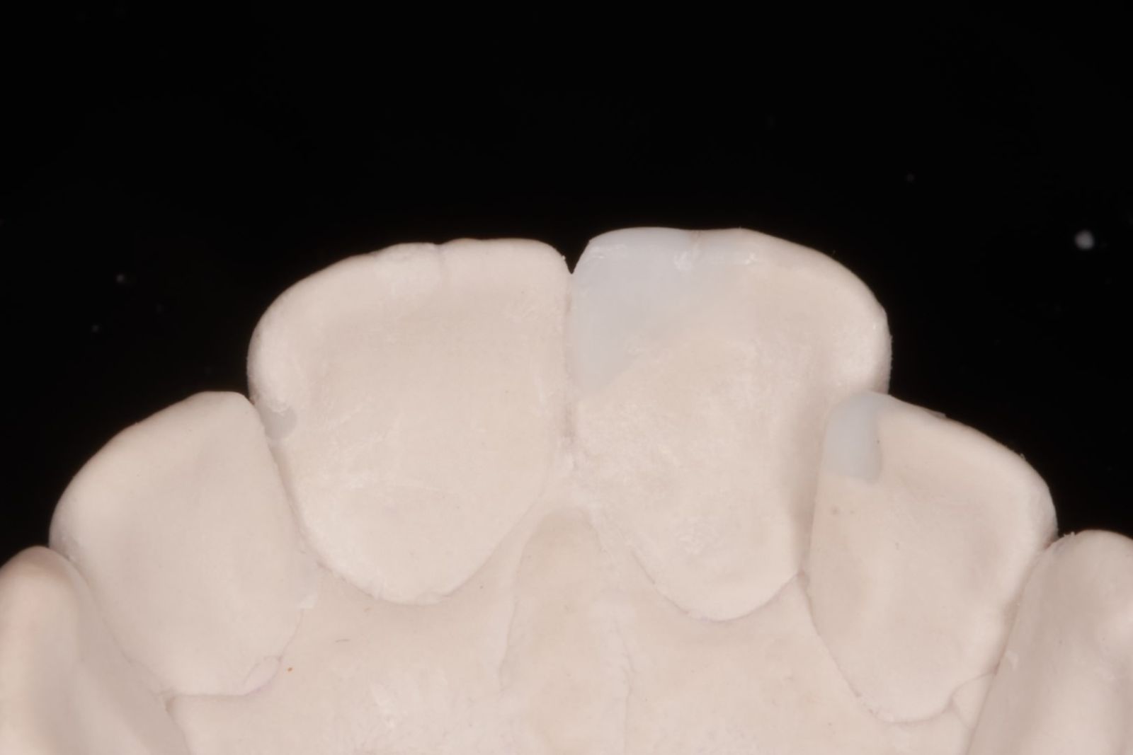 Frontal Incisor Composite Restoration