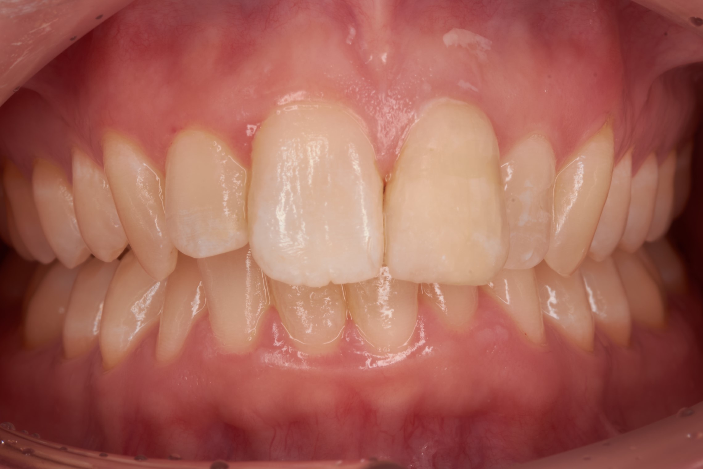 Frontal Incisor Composite Restoration