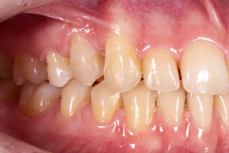Ceramic Tooth Reconstruction