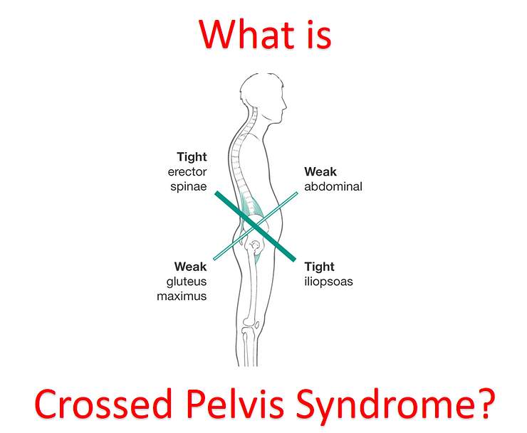 What is Crossed Pelvis Syndrome?