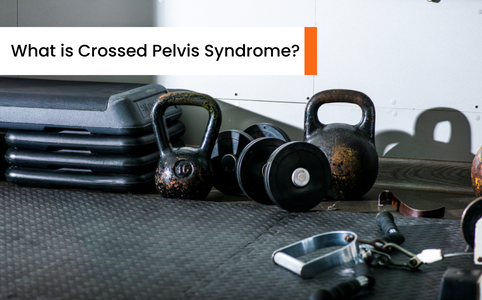 What is Crossed Pelvis Syndrome?