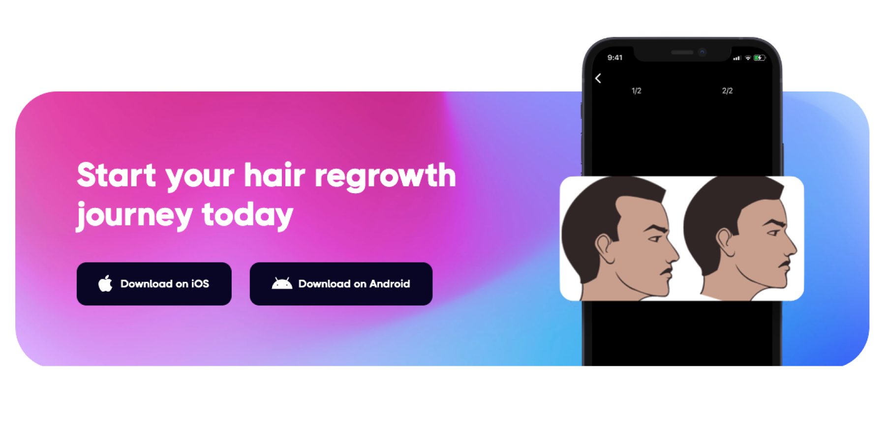 Hairly - Your Hair Regrowth Assistant | Install for Free