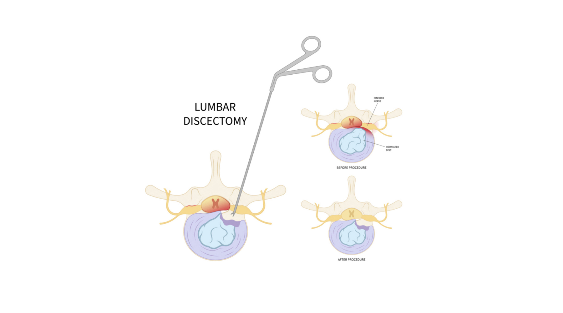 Lumbar Discectomy | Spine Care