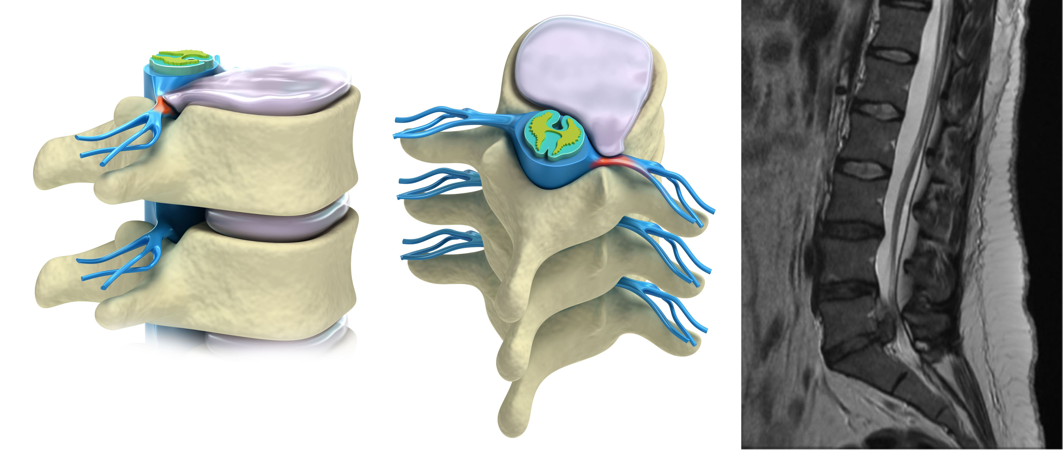 Lumbar Discectomy | Spine Care